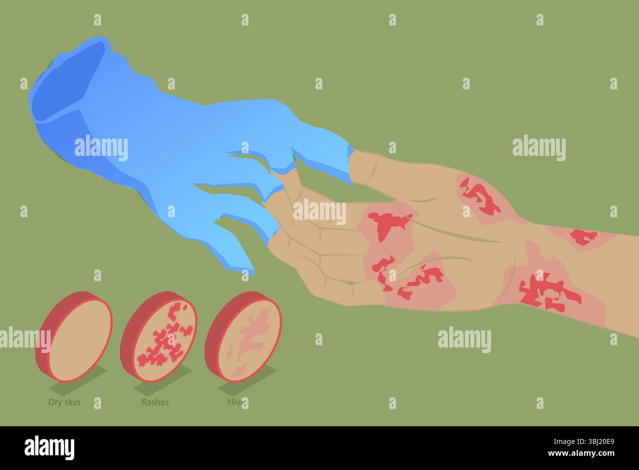 3D Isometric Flat Illustration of Latex Allergy, Skin Reactions From ...