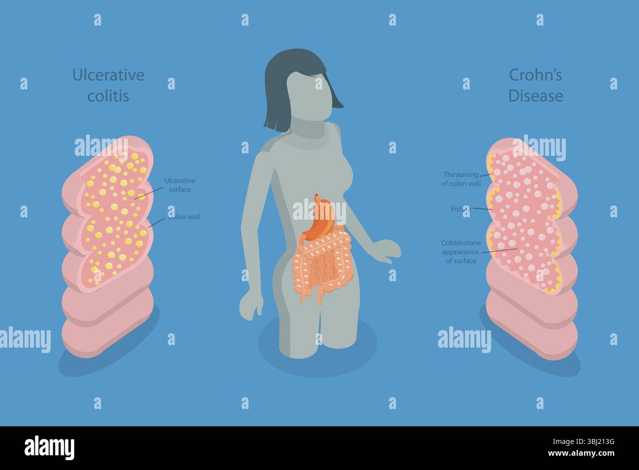 3D Isometric Flat Illustration of IBD, Educational Diagram for ...