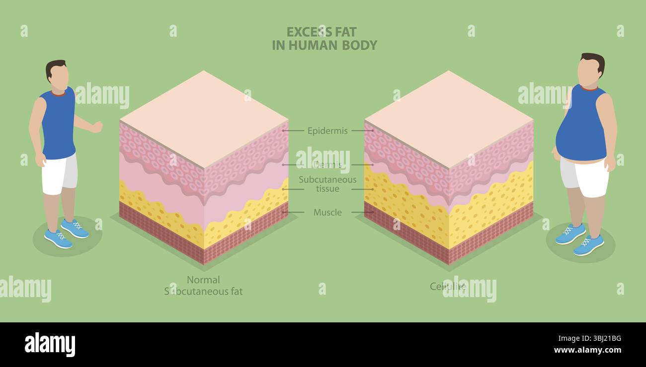 3D Isometric Flat Illustration of Human Body Excess Fat, Obesity Stock ...