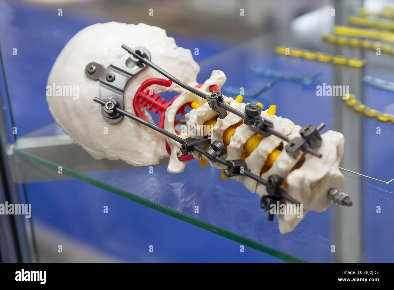 Spinal fixation surgery model with metal implants. Medicine Stock Photo ...