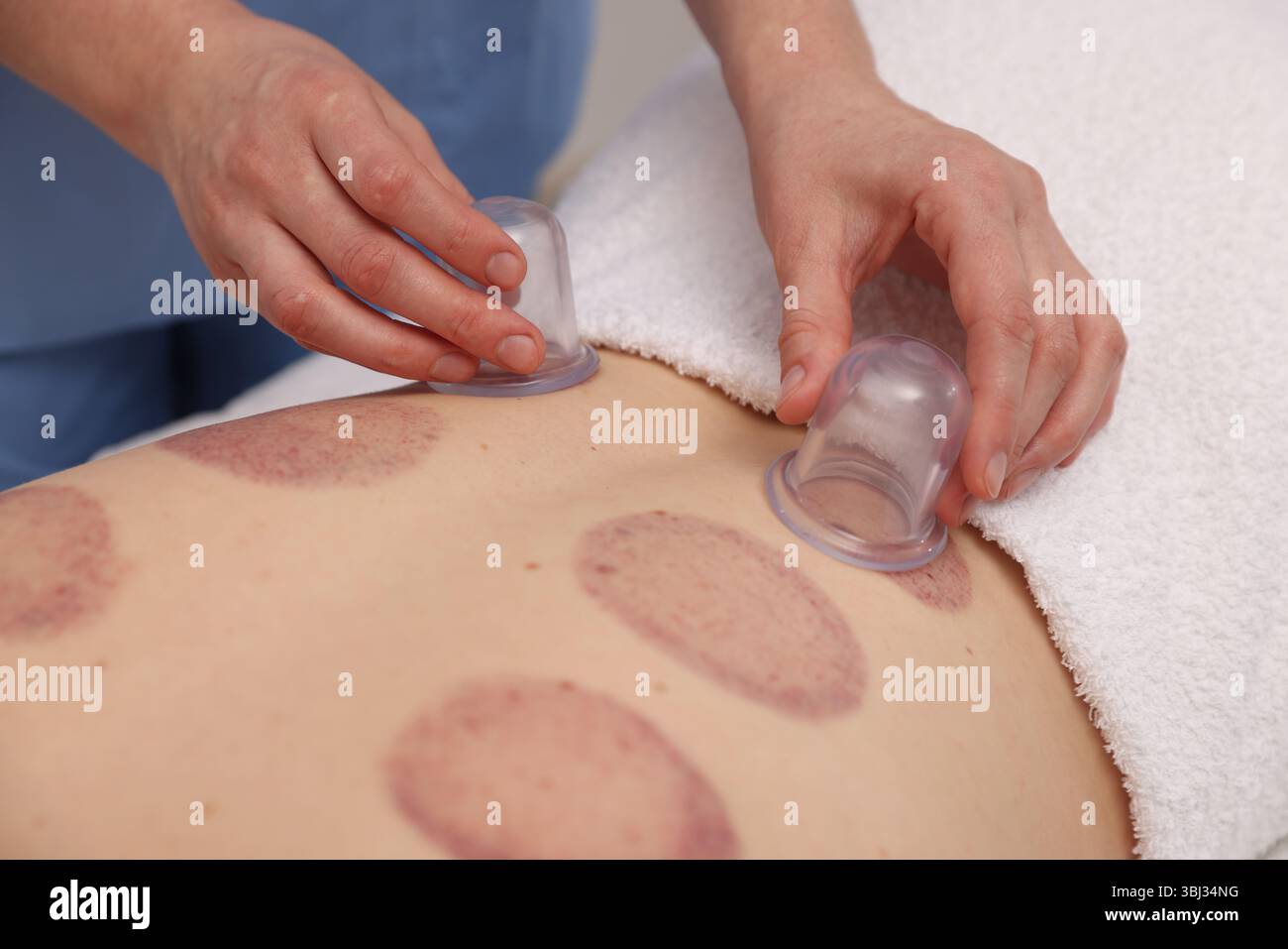 Therapist giving cupping treatment to patient in spa salon, closeup ...