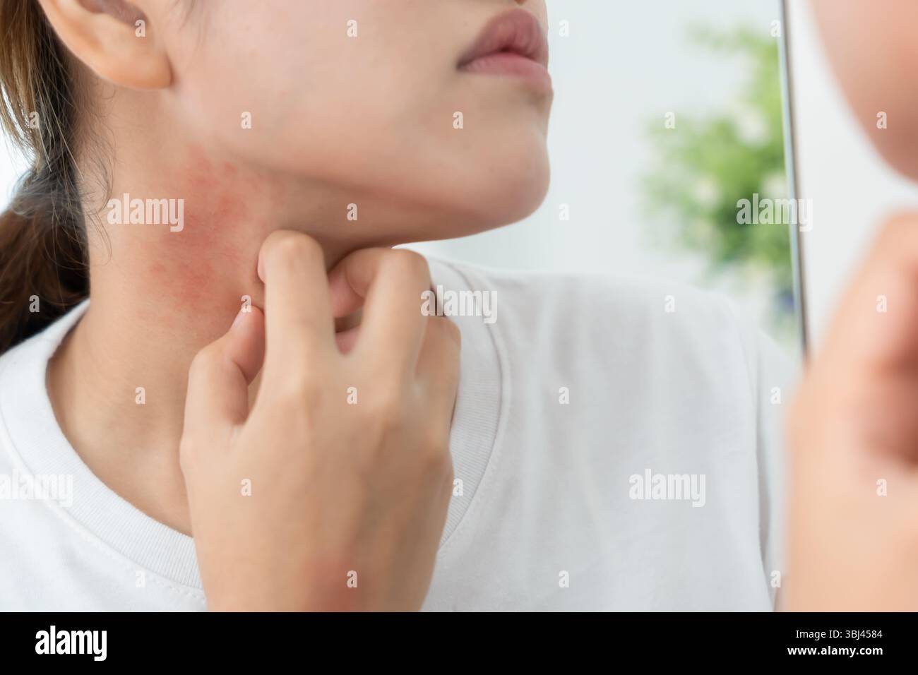 skin problem and beauty. Young woman scratch body has itchy skin from skin allergic, steroid ...