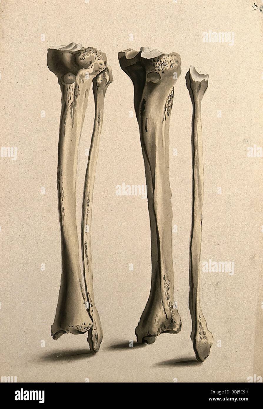 Tibia and fibula bones, 1830-1835 Stock Photo - Alamy