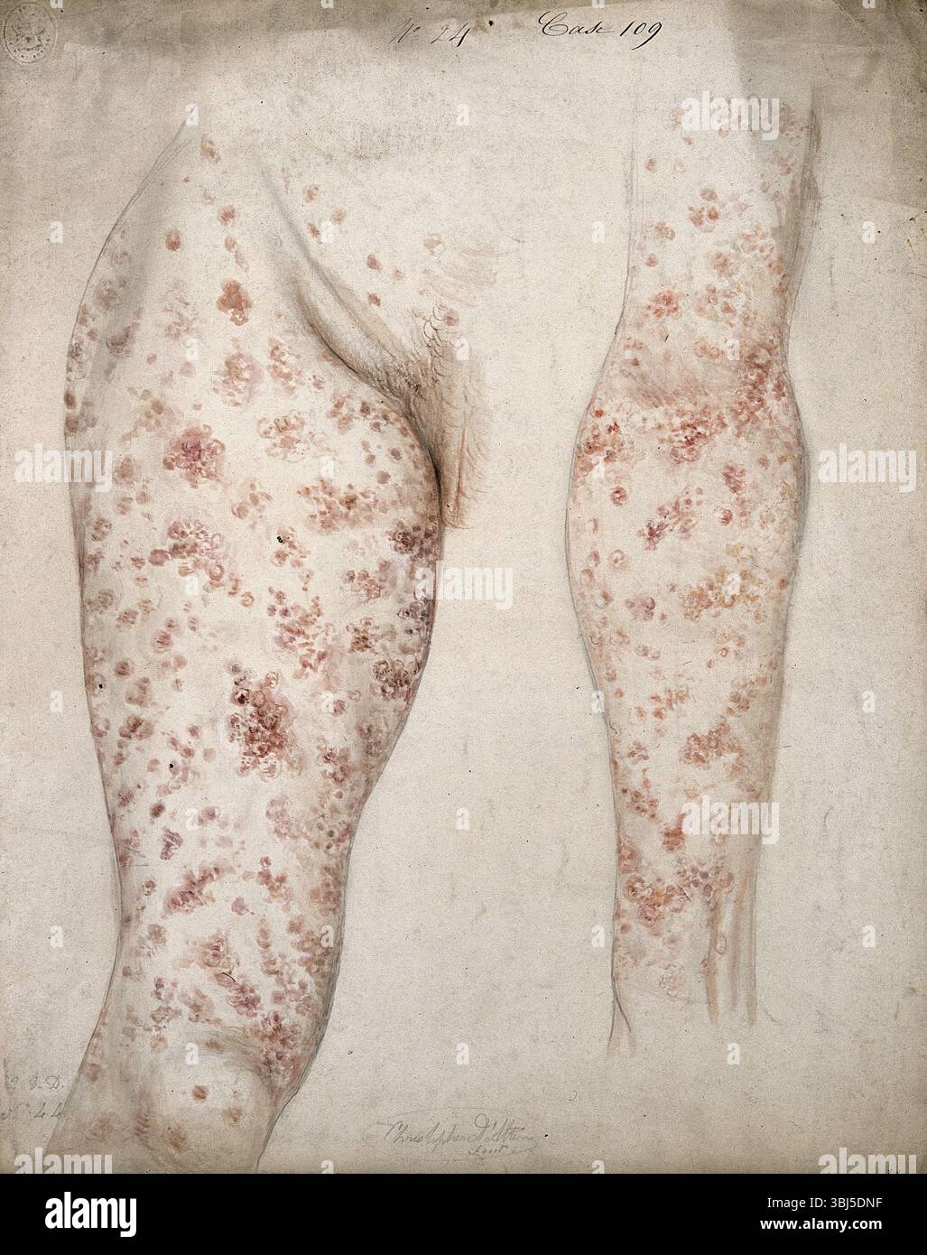 Sores and diseased skin on the leg and arm of a woman, 1856 Stock Photo ...