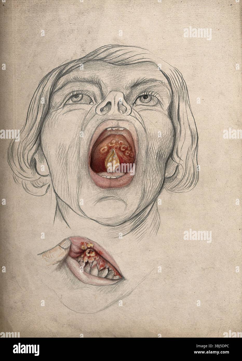 The face of a man, with mouth open wide, displaying diseased areas of ...