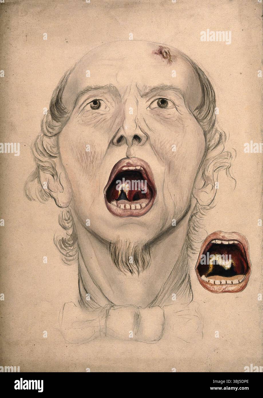 The face of a man, with mouth open wide, displaying a diseased area of ...