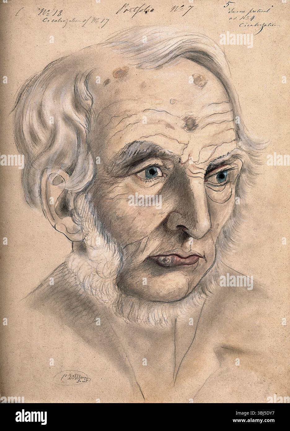 A man suffering from chancre of the lip, displaying scar tissue on his ...