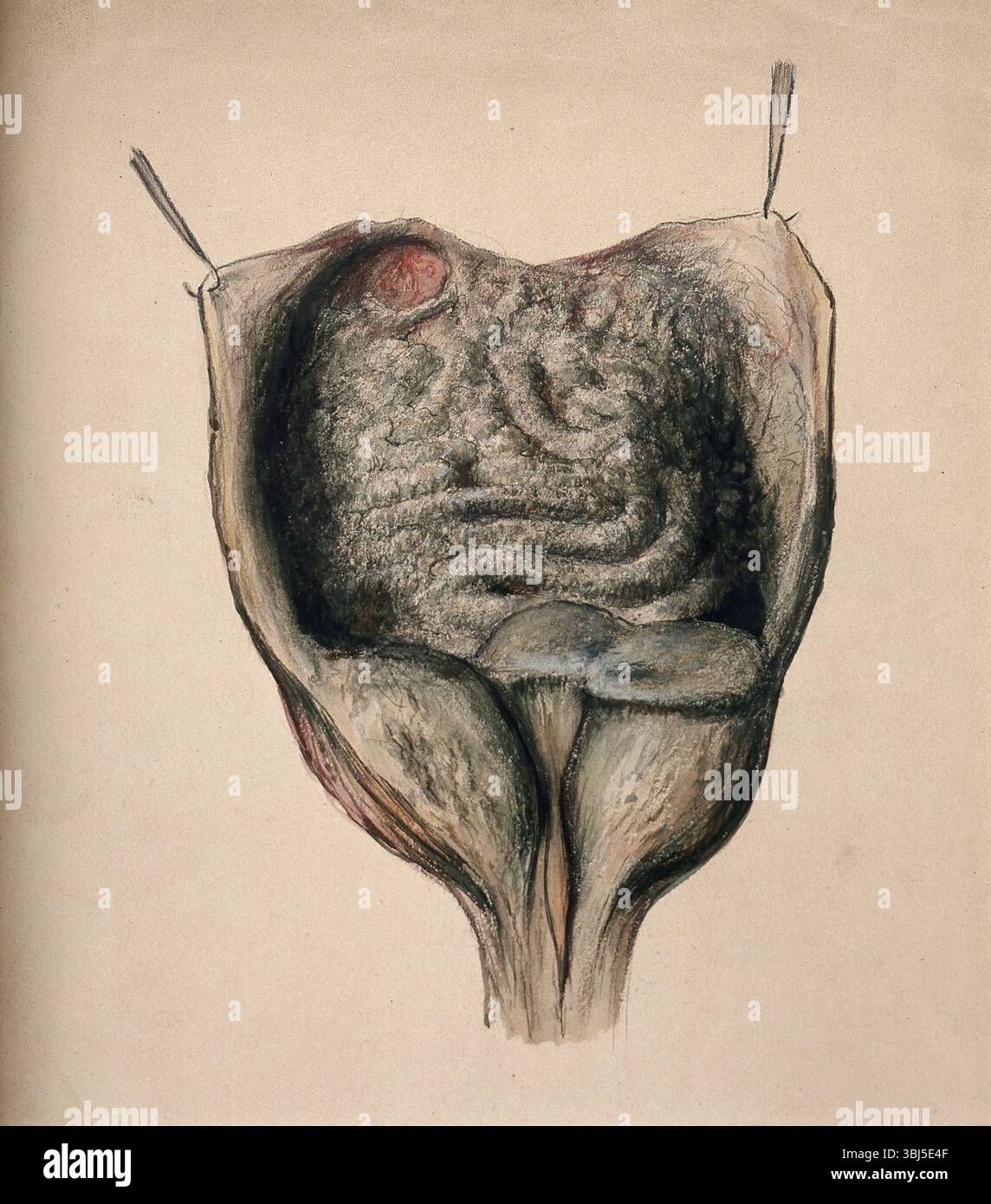 Dissection of diseased intestines, (1851 Stock Photo - Alamy