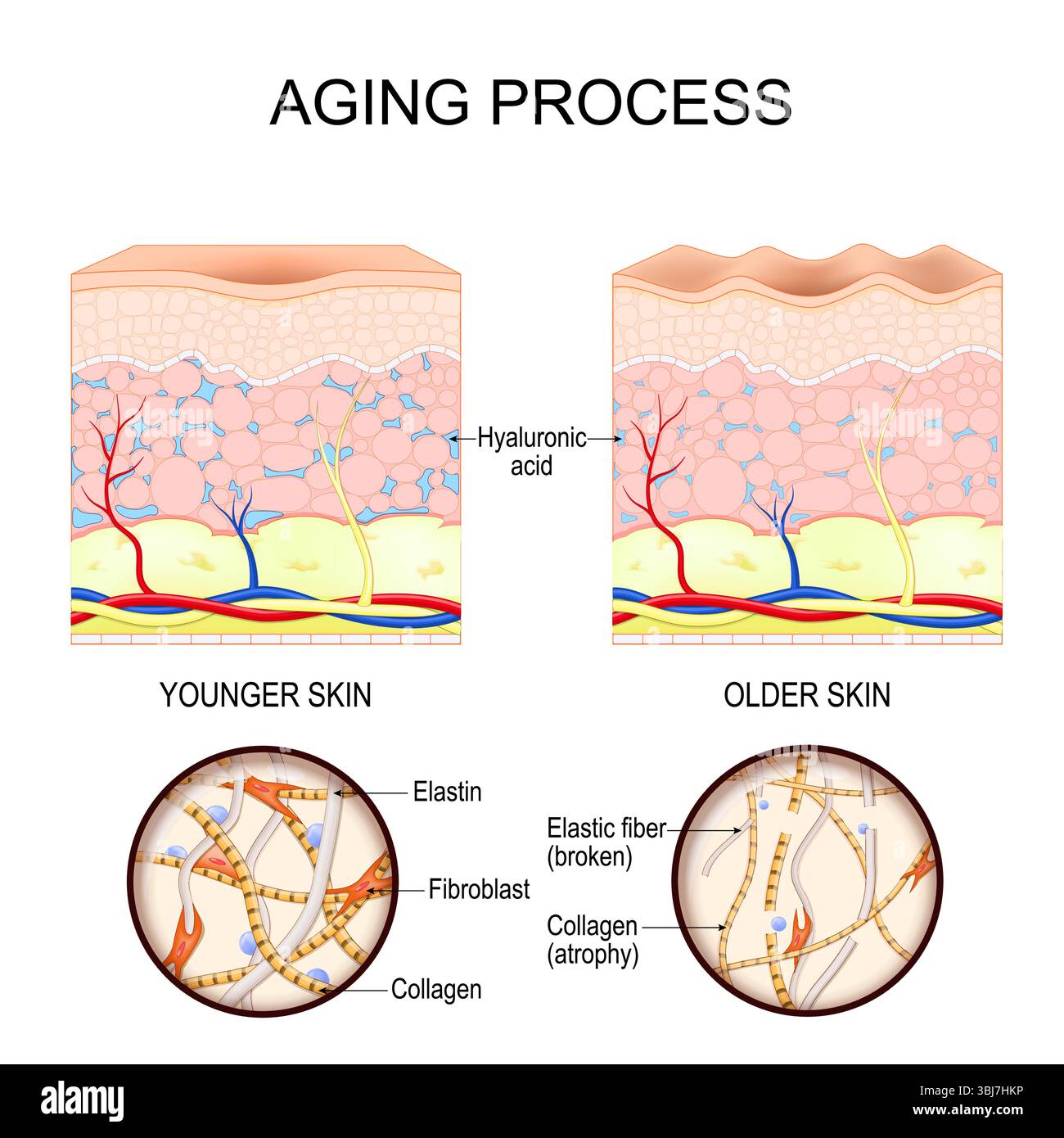 Aging process. Younger and older skin. Close-up of collagen and elastin fibers, and fibroblasts ...