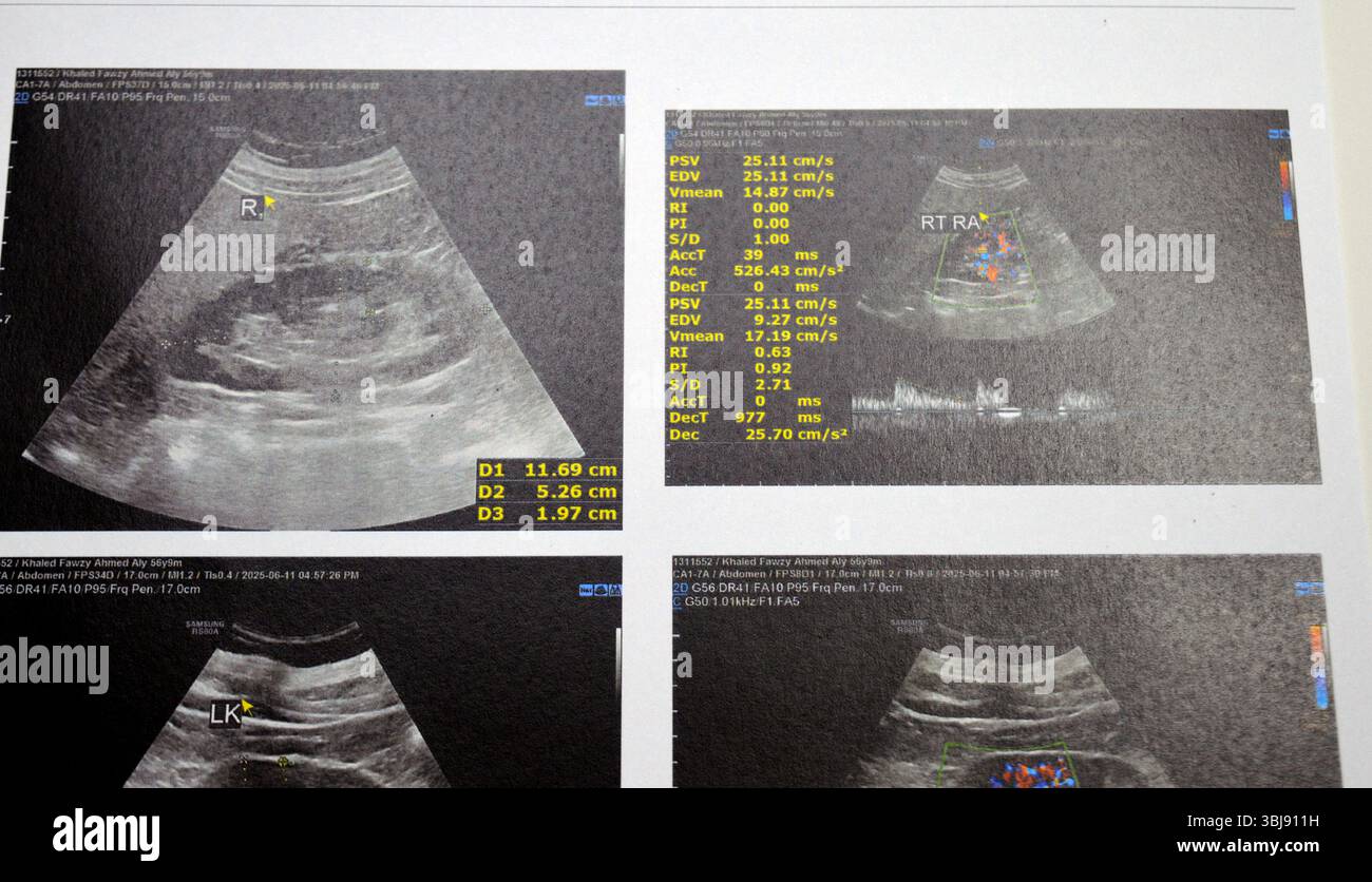 Cairo, Egypt, June 12 2025: Normal renal sonographic examination with ...