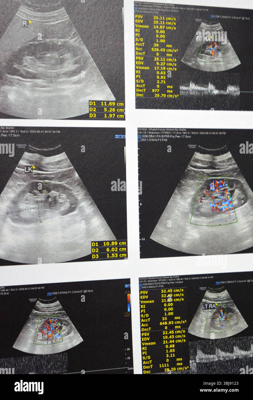 Cairo, Egypt, June 12 2025: Normal renal sonographic examination with ...