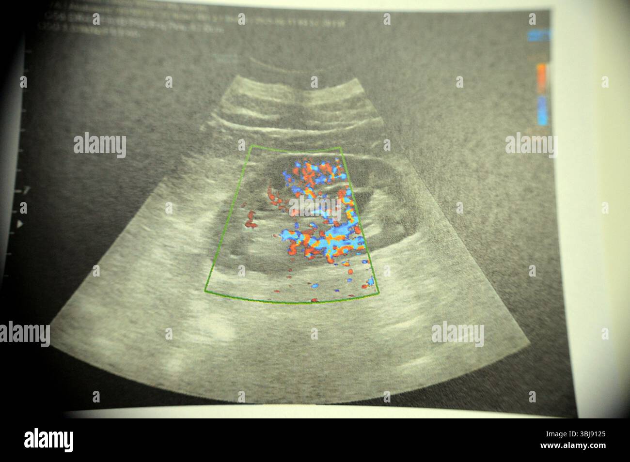 Cairo, Egypt, June 12 2025: Normal renal sonographic examination with ...