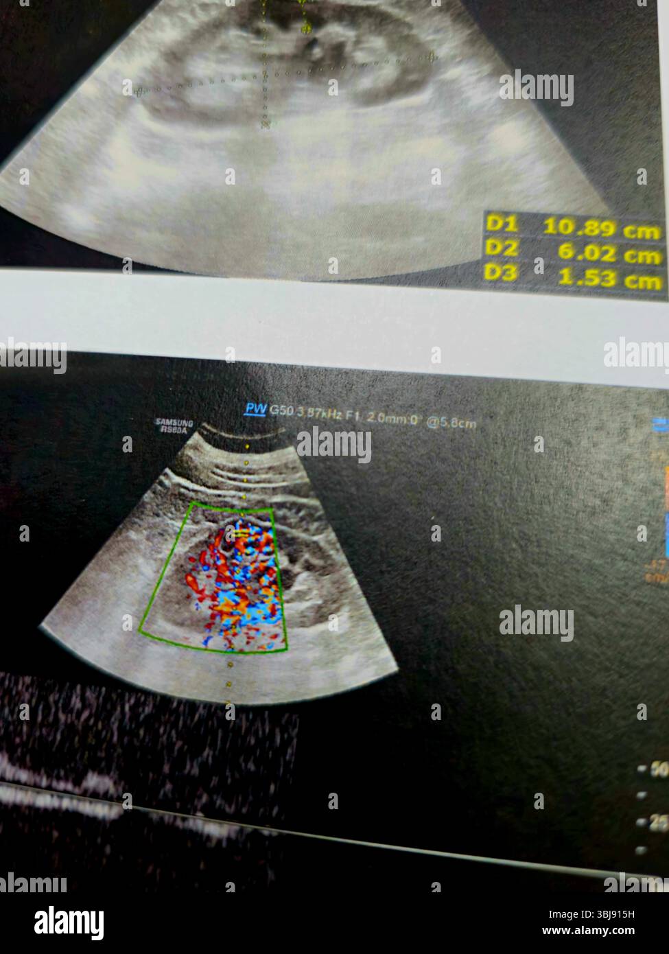 Normal renal sonographic examination with normal duplex doppler study ...