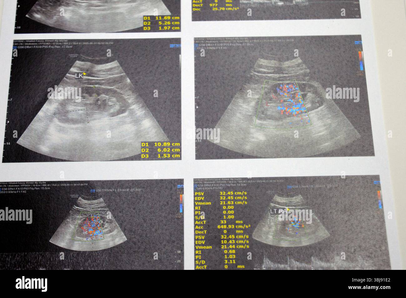 Cairo, Egypt, June 12 2025: Normal renal sonographic examination with ...