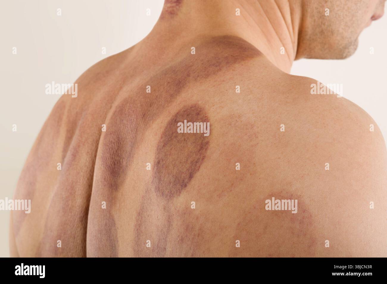 Cupping therapy marks on handsome man's back Stock Photo - Alamy