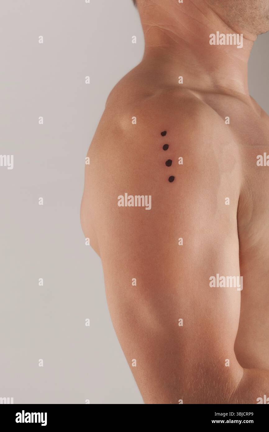 Handsome man with sapo burns - dots on shoulder isolated. Kambo ...
