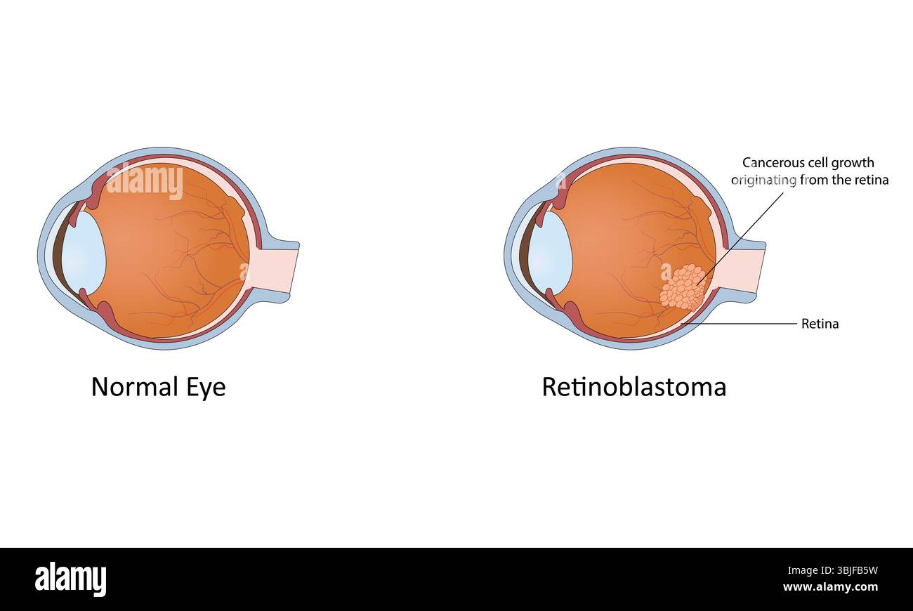 Retinoblastoma vector illustration Stock Vector Image & Art - Alamy