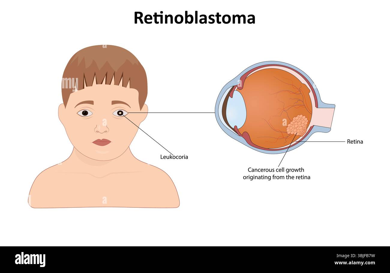 Retinoblastoma vector illustration Stock Vector Image & Art - Alamy