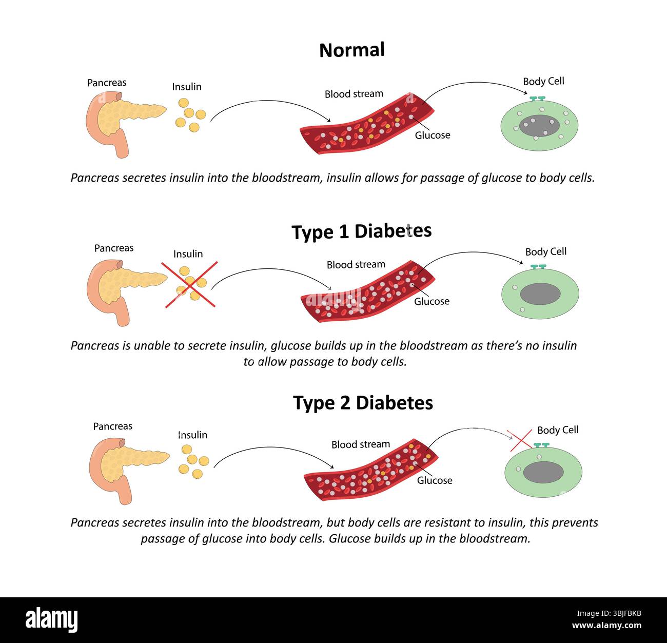 Diabetes mellitus type 1 and type 2 vector illustration Stock Vector ...