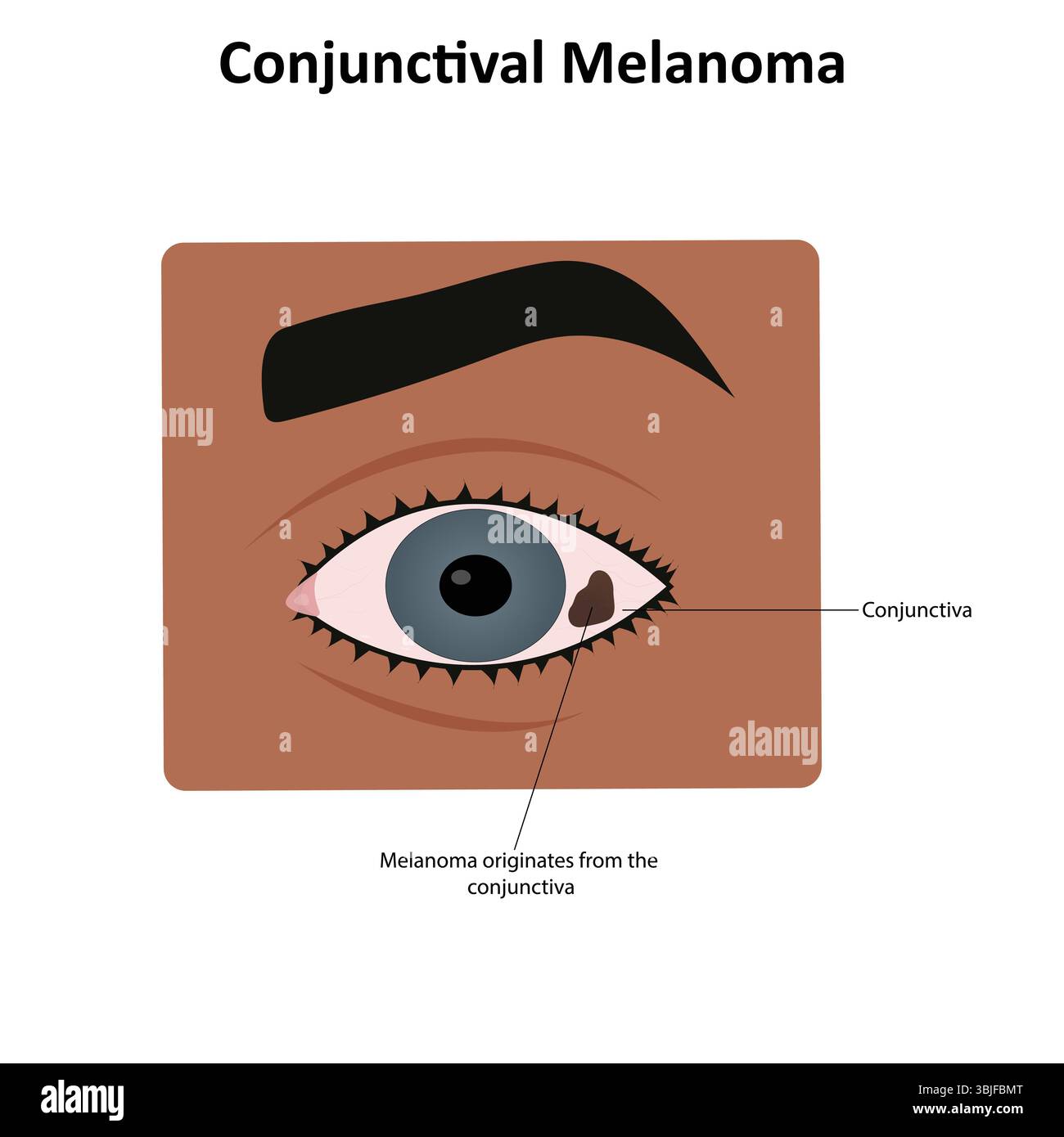 Conjunctival melanoma vector illustration Stock Vector Image & Art - Alamy