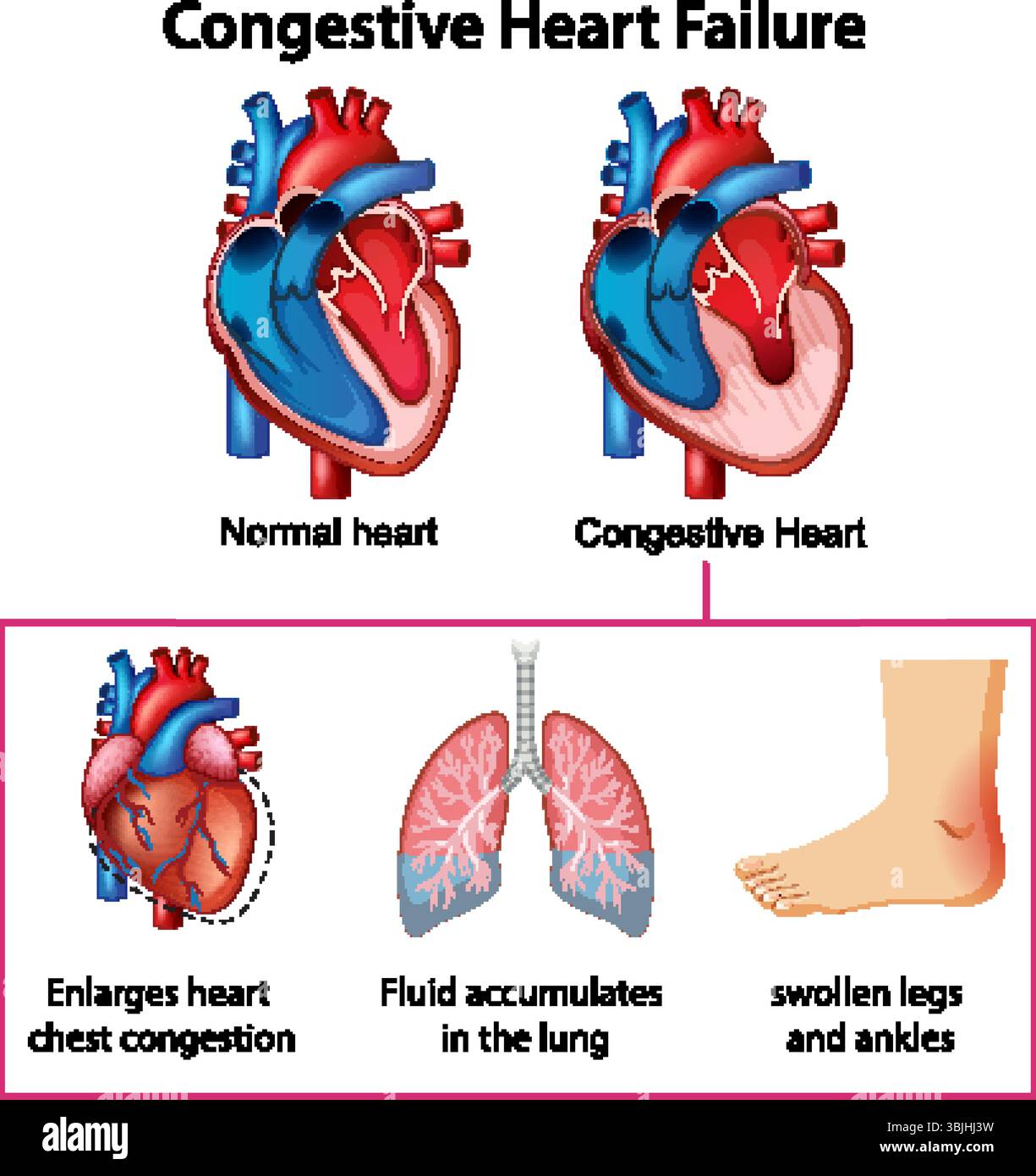 Detailed vector illustration comparing normal and congestive heart conditions, highlighting ...