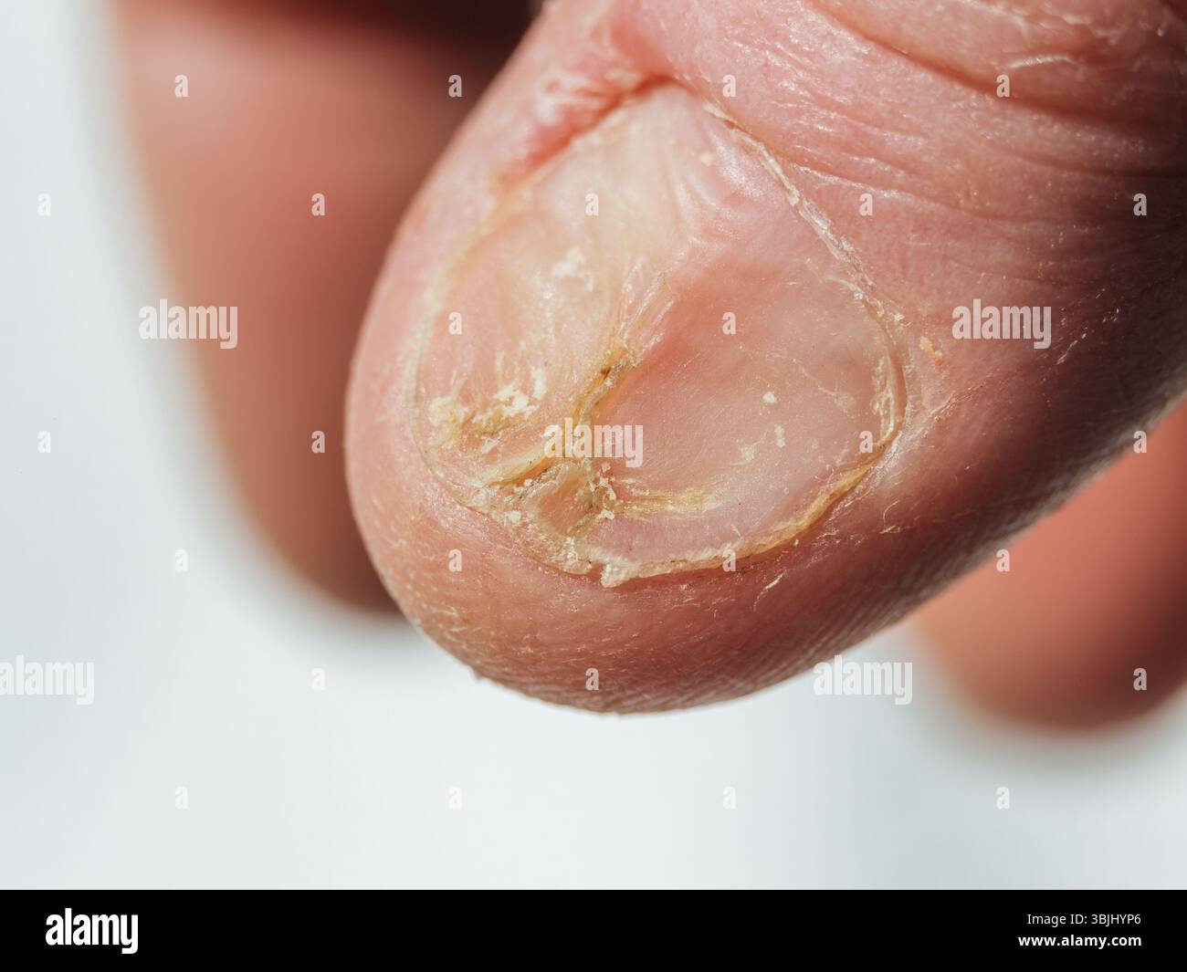 Close-up of a crack and damage to the nail plate of a thumb Stock Photo ...