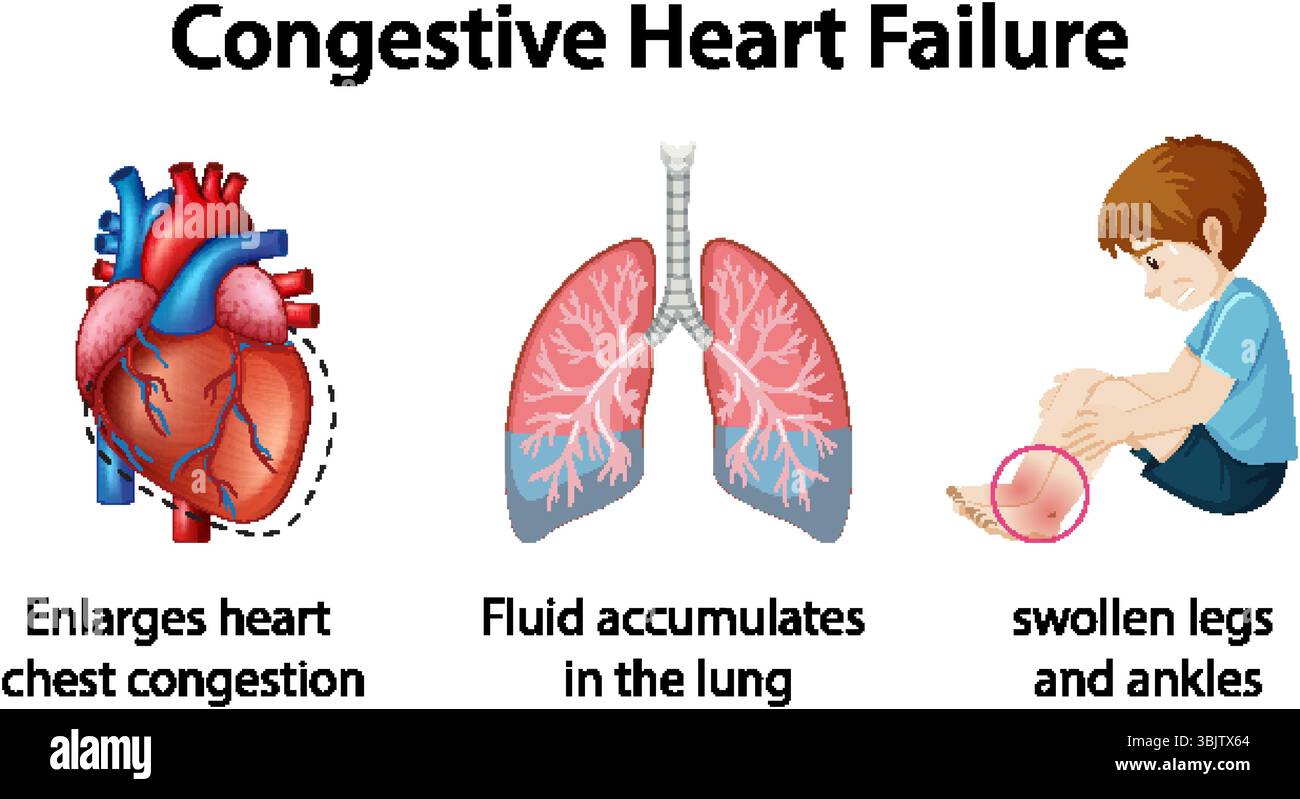 Vector illustration showing symptoms of congestive heart failure with labeled diagrams of heart ...