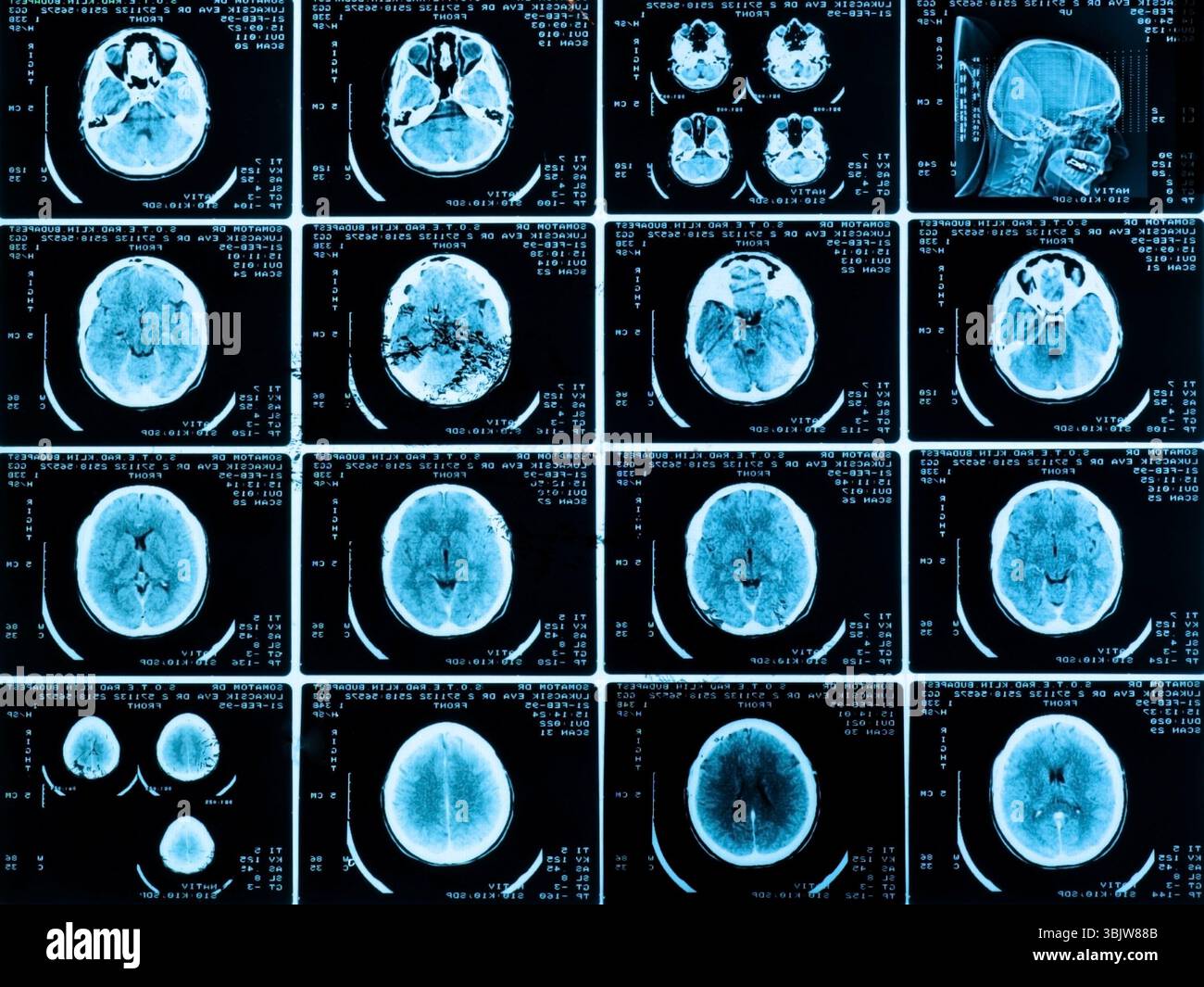 Scans of the brain Stock Photo - Alamy