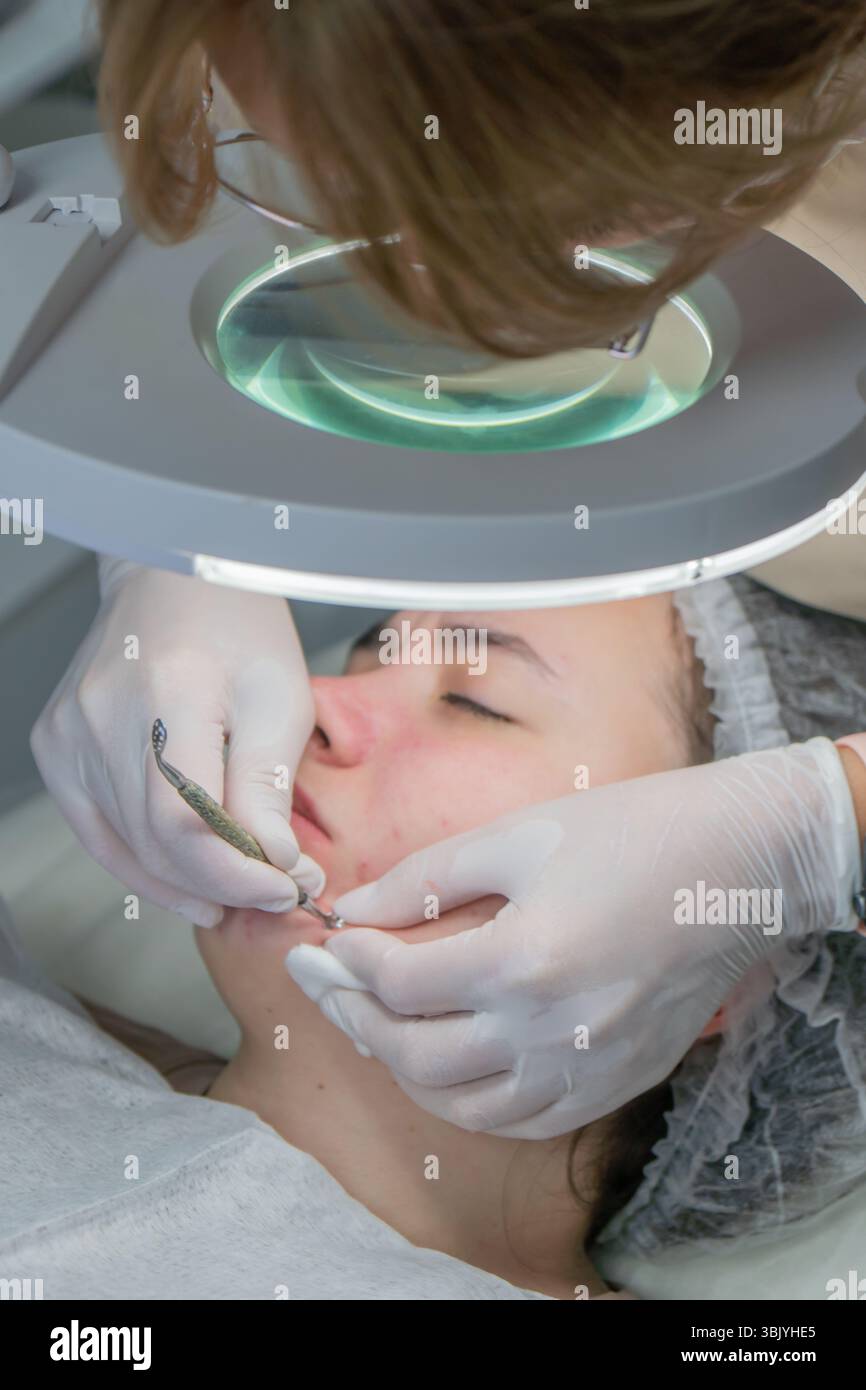 Dermaplaning, Face, Treatment: Clinic procedure removing facial hair ...