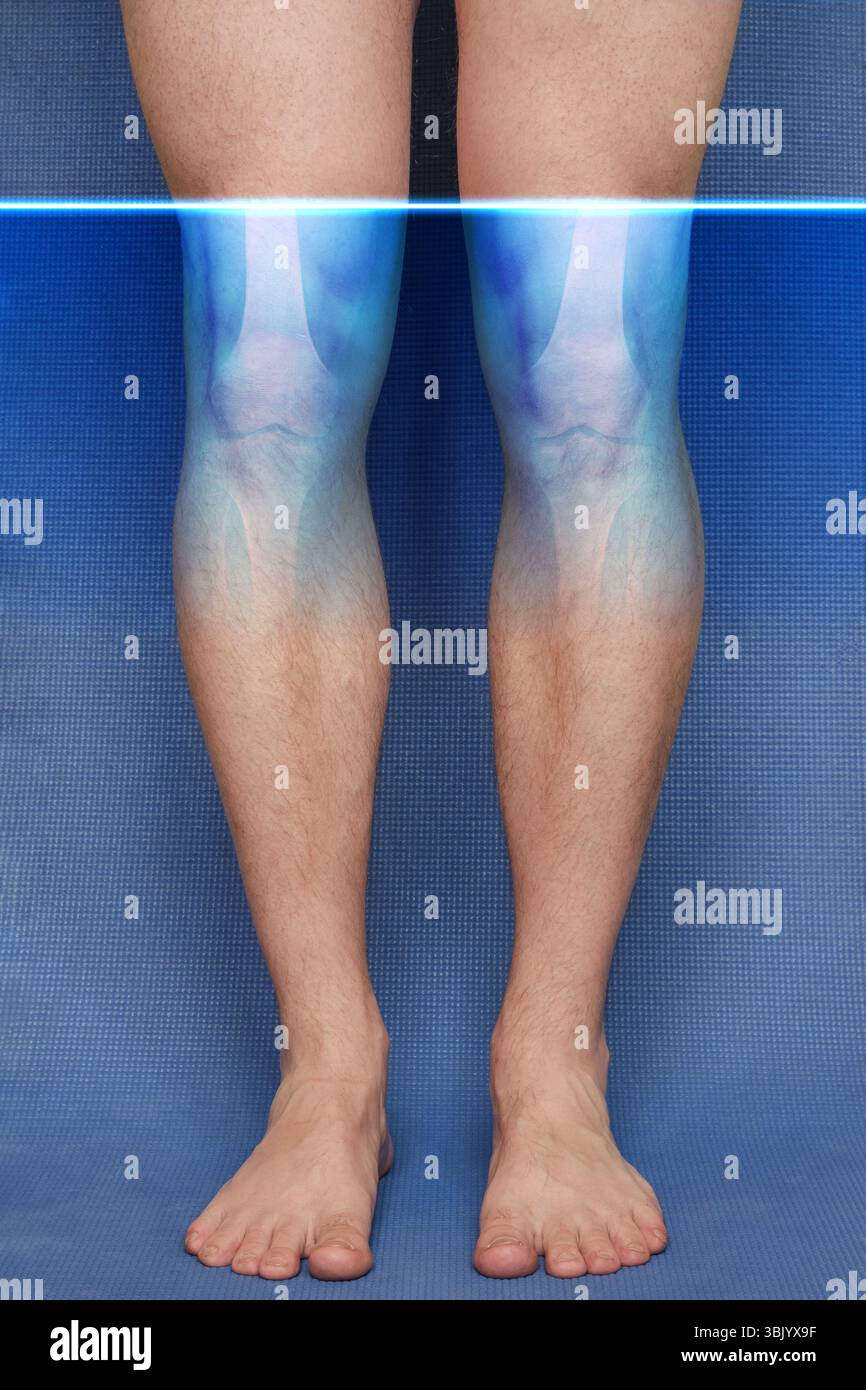 Composite image showing a man's knees under X-ray — blending visible ...