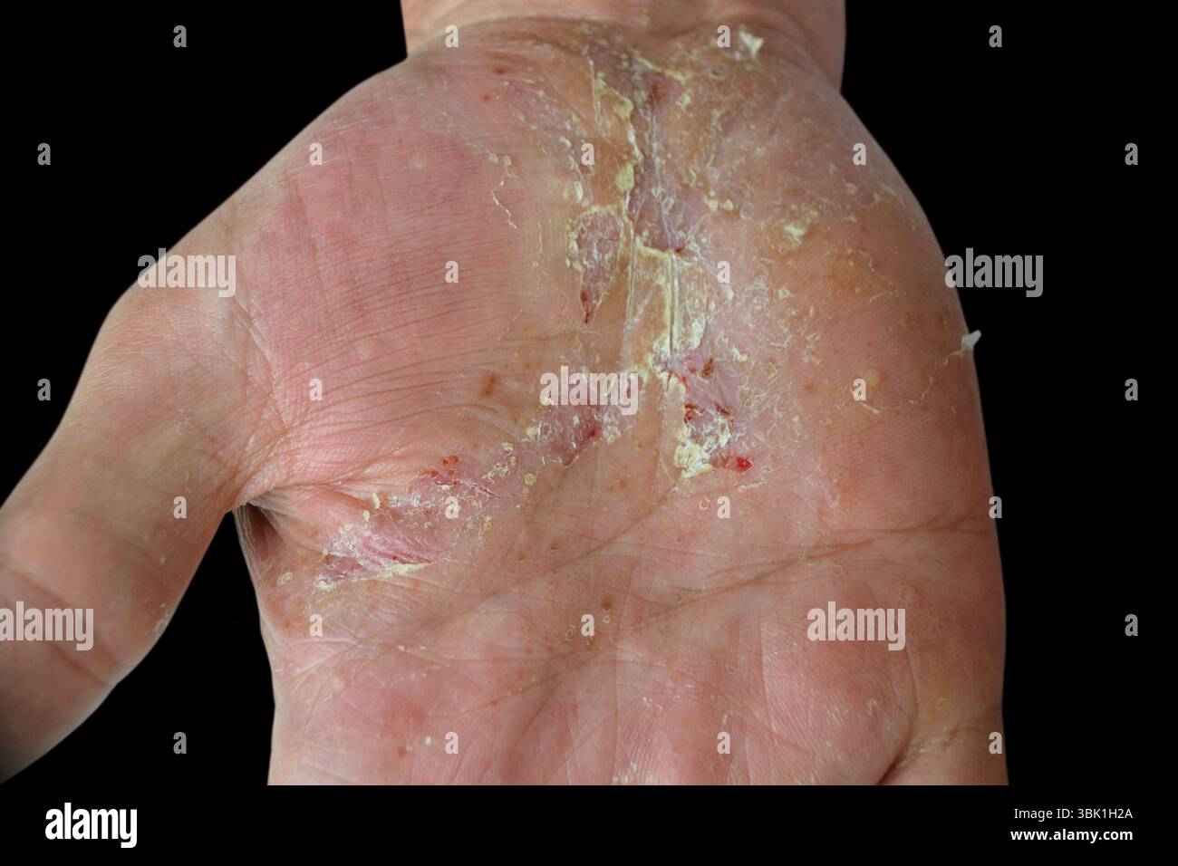 Palmoplantar pustular psoriasis on the palm of a 54 year old male ...