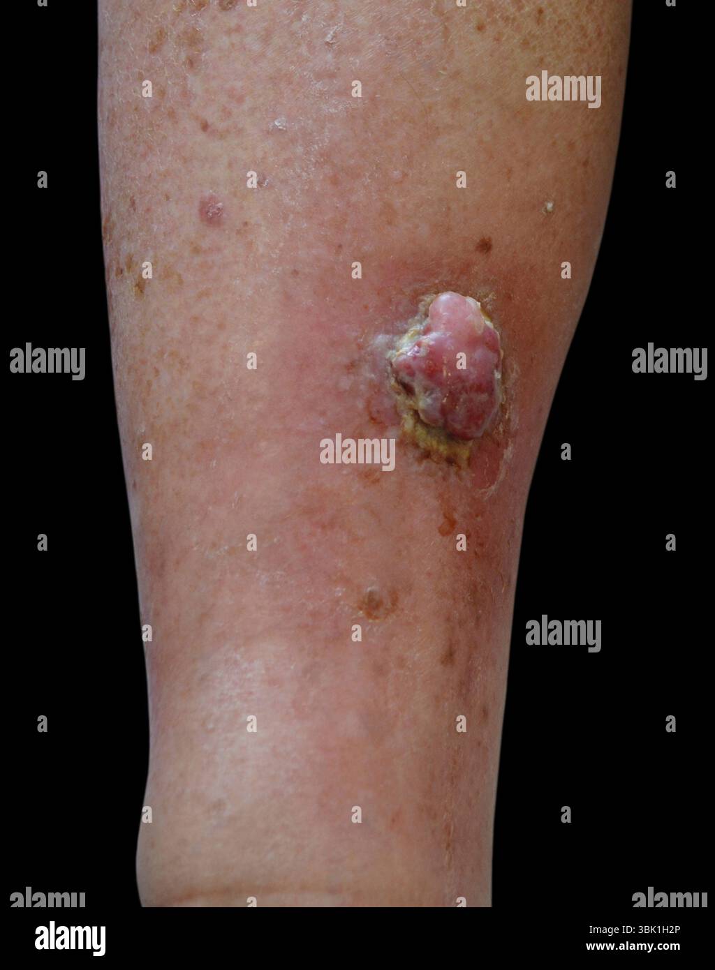Squamous cell carcinoma (SCC) on the leg of a 66 year old male patient ...