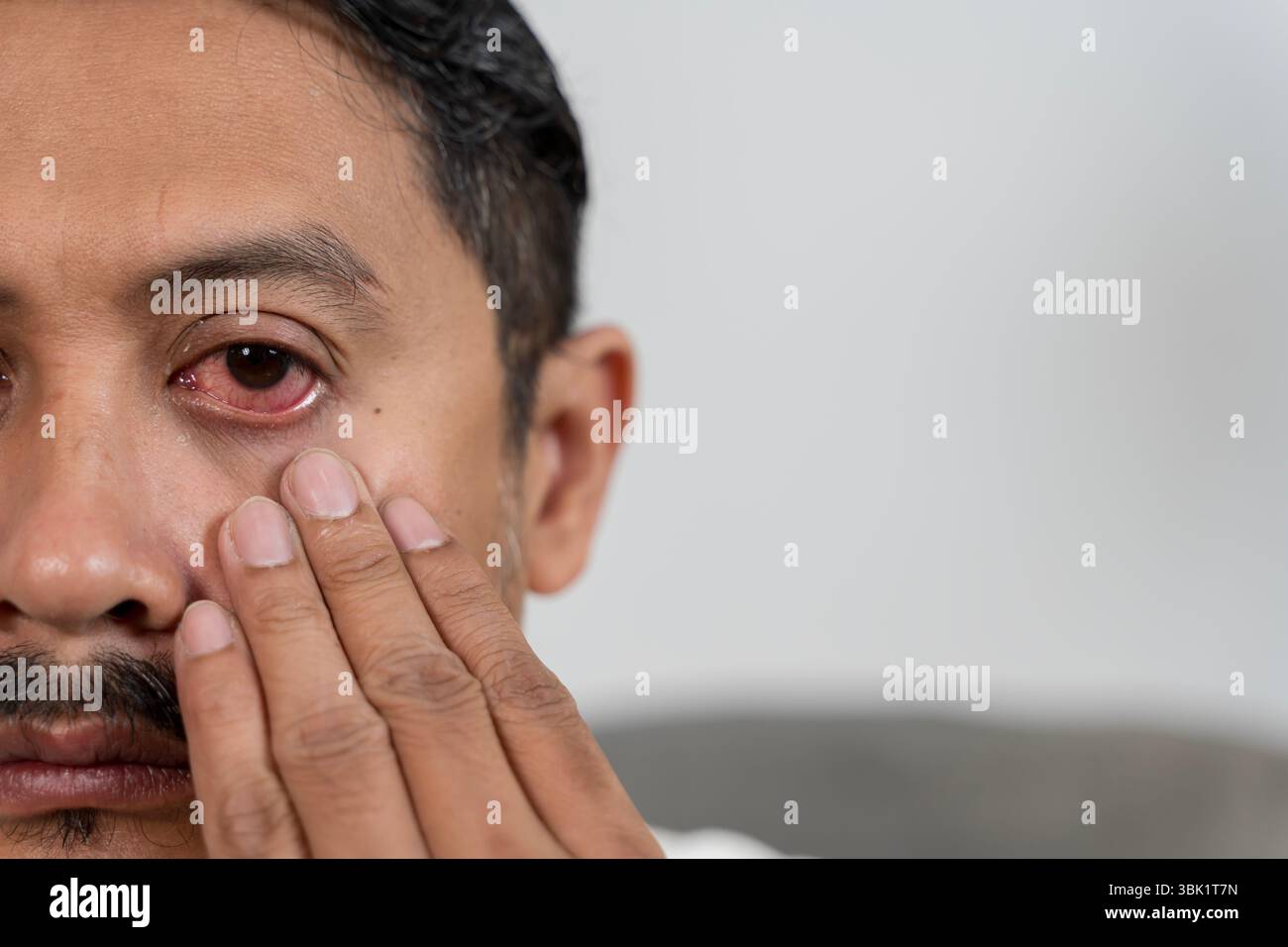 Close-up of an Asian man's face with irritated red eye, possibly caused ...