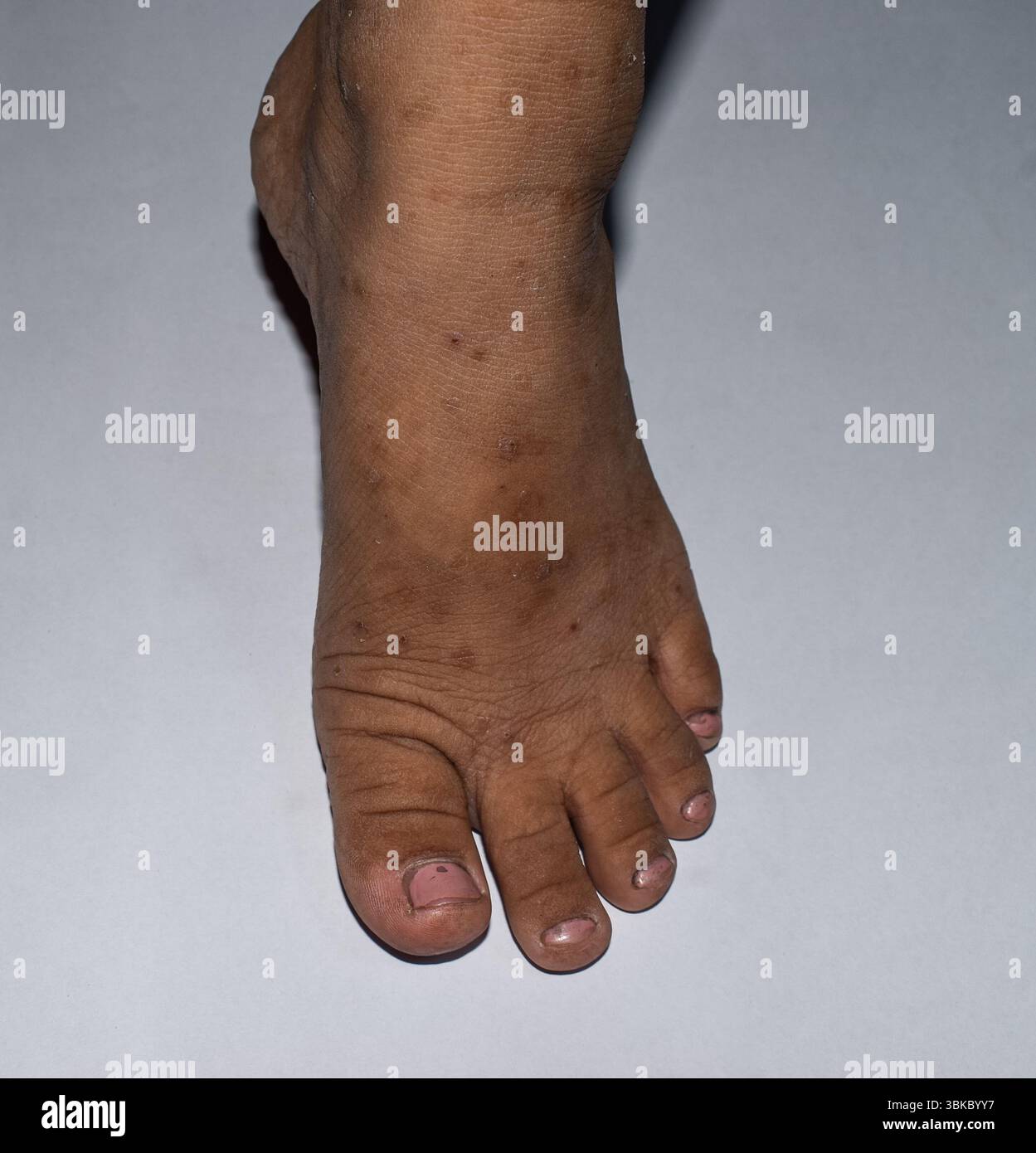 Scabies affected skin hi-res stock photography and images - Alamy