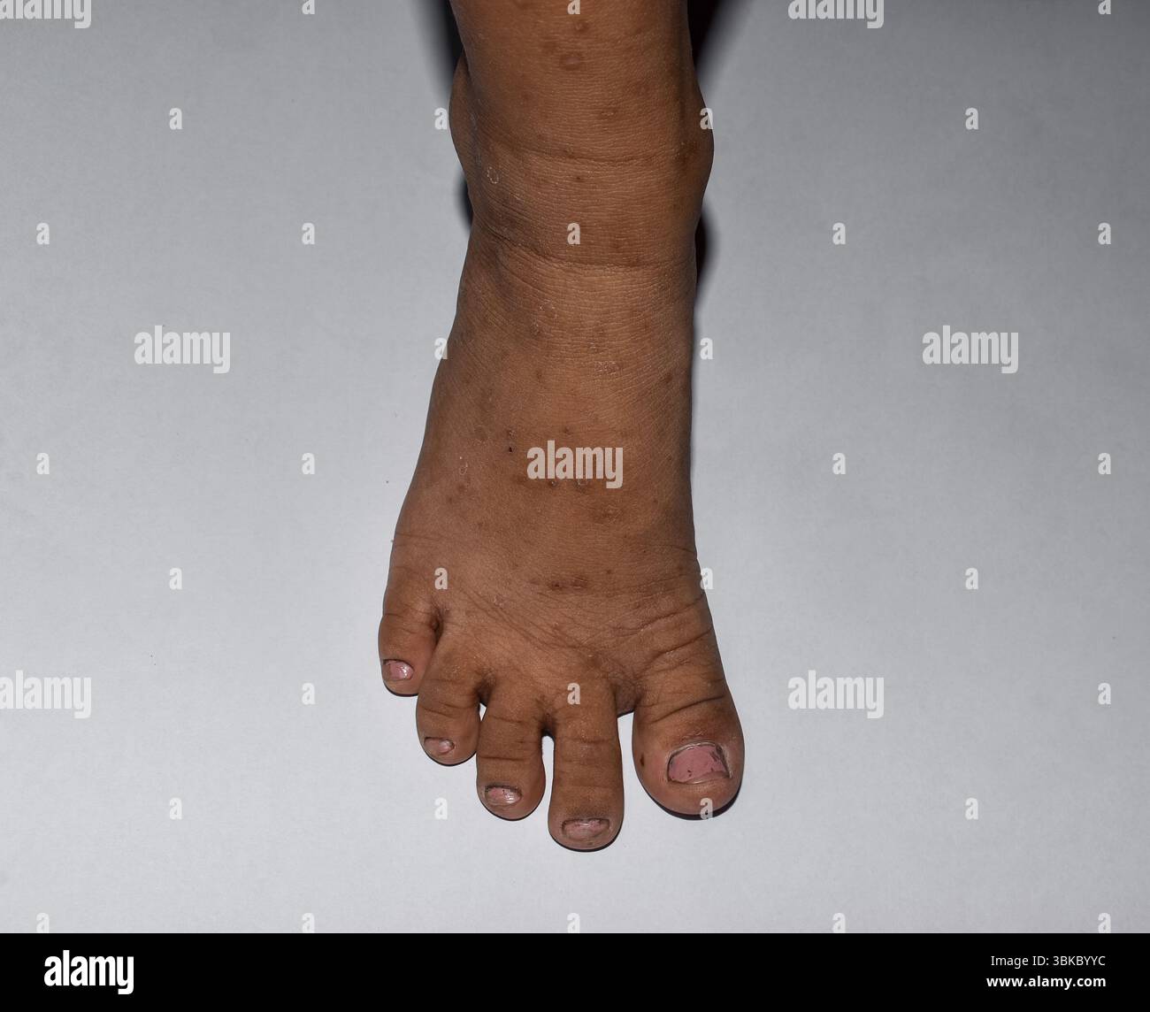 Sepsis skin hi-res stock photography and images - Alamy