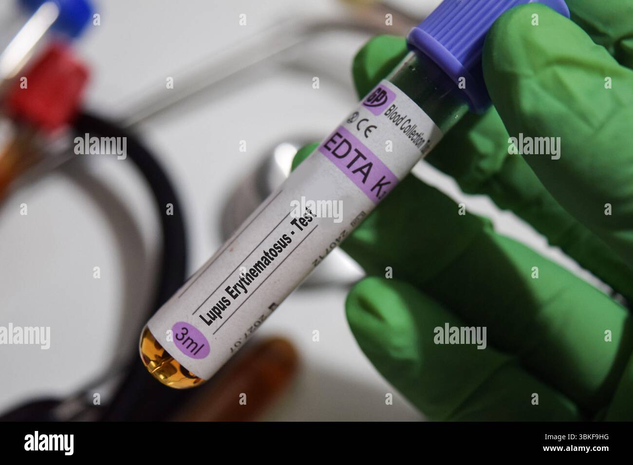 Lupus Erythematosus - Test with blood sample. Top view isolated on ...