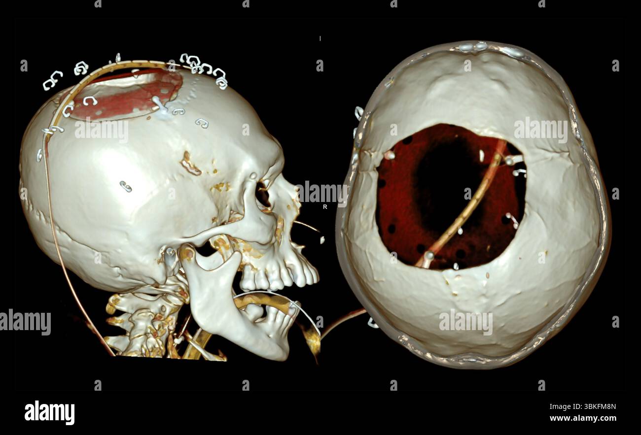 Coloured 3D computed tomography (CT) scans of the brain and skull after ...