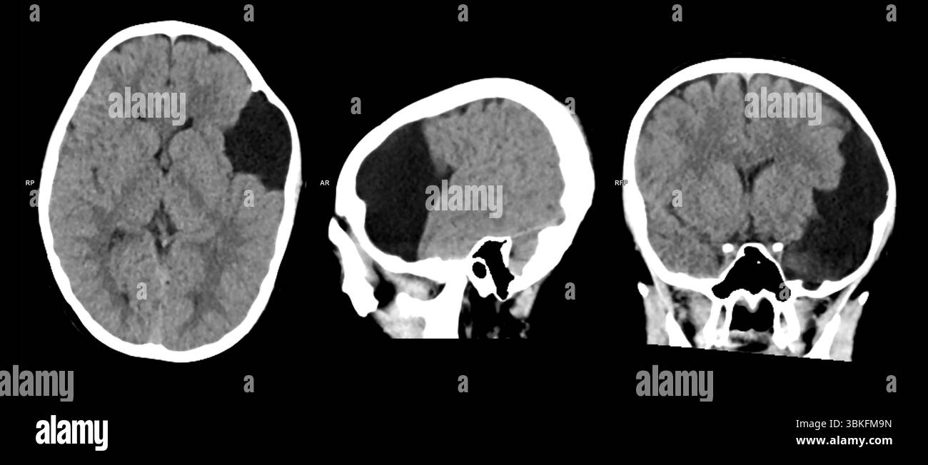 Computed tomography (CT) scans of a brain with an arachnoid cyst Stock ...