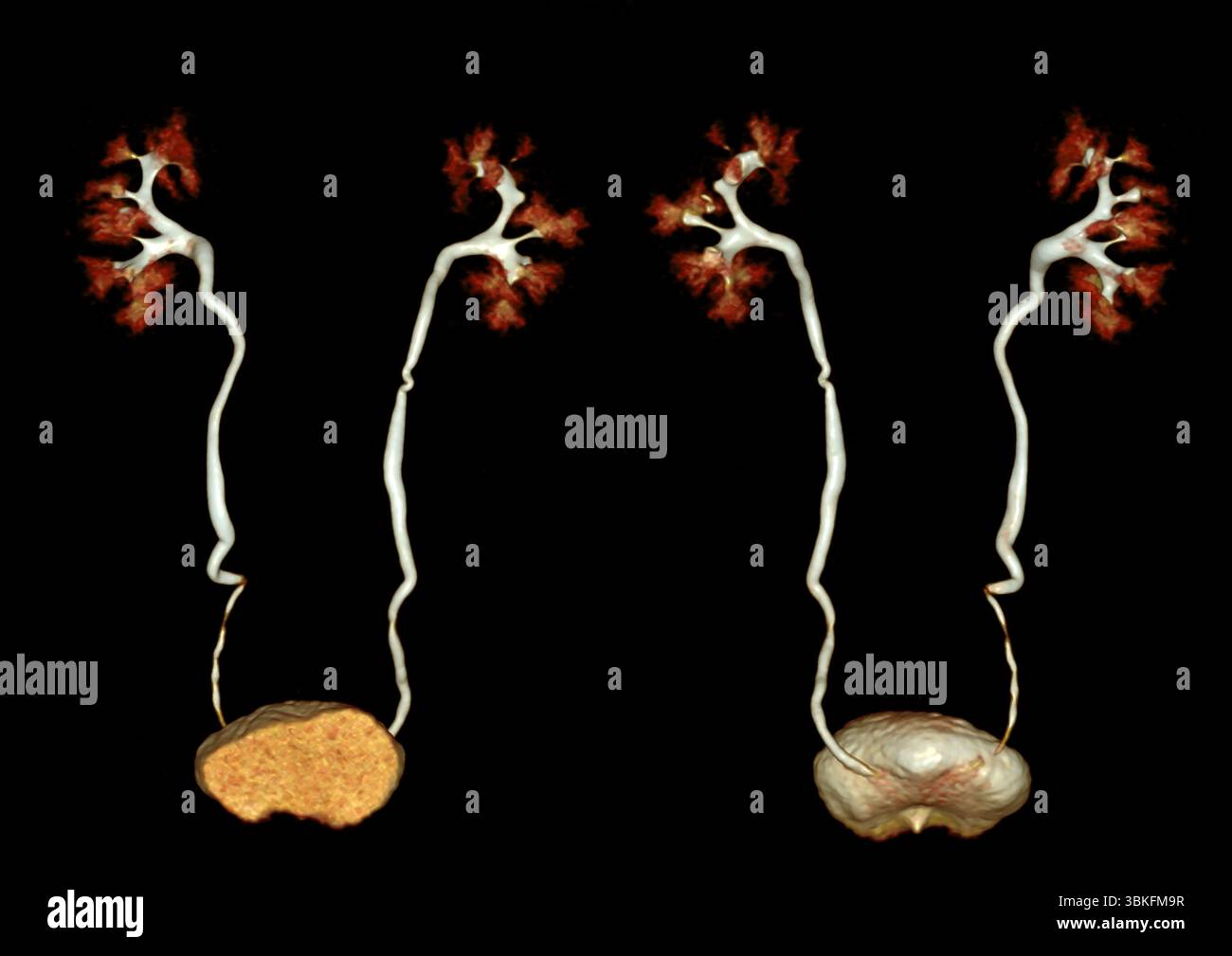 Coloured d 3D computed tomography (CT) scans showing ...