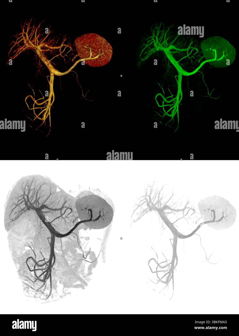 Coloured 3D computed tomography (CT) angiogram scans of the portal, splenic and mesenteric veins ...