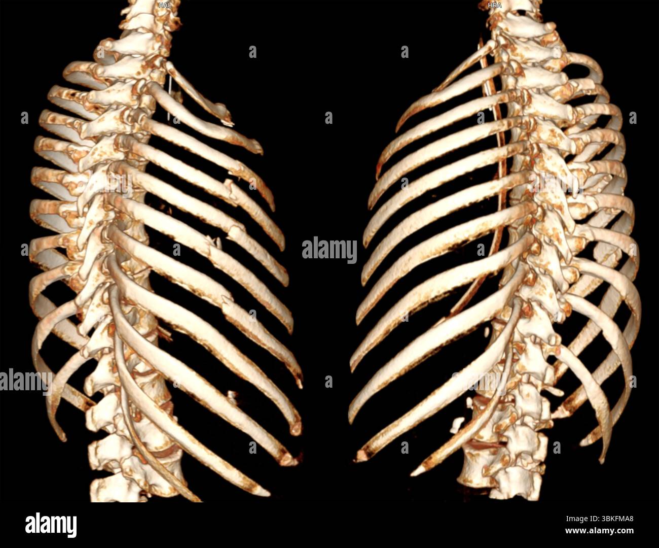 Rib fracture hi-res stock photography and images - Alamy