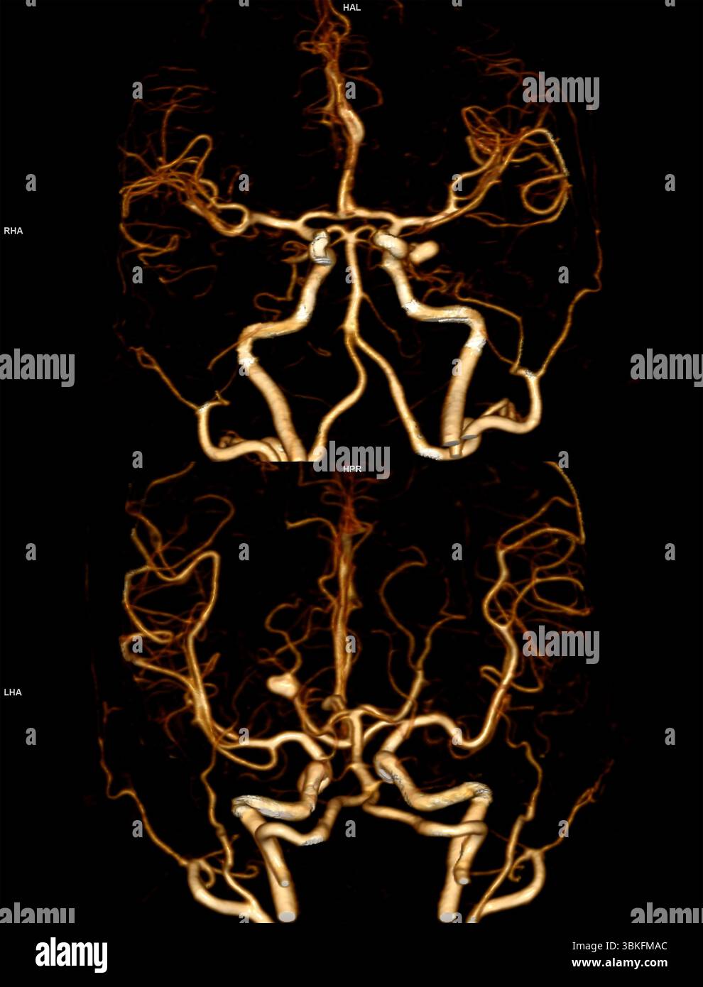 Coloured 3D computed tomography (CT) angiogram scans of an aneurysm in the left posterior ...