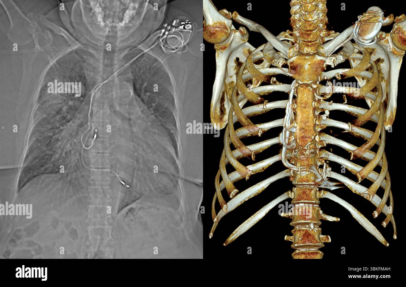 X-ray (left) and coloured computed tomography (CT) scan (right) of an ...