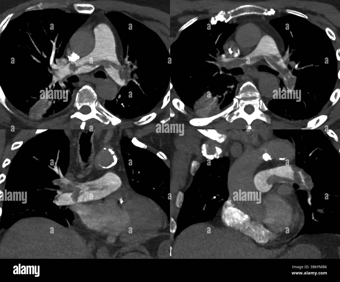Pulmonary artery blood clot Black and White Stock Photos & Images - Alamy