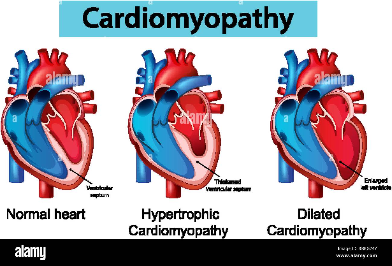 Detailed vector illustration of normal, hypertrophic, and dilated ...