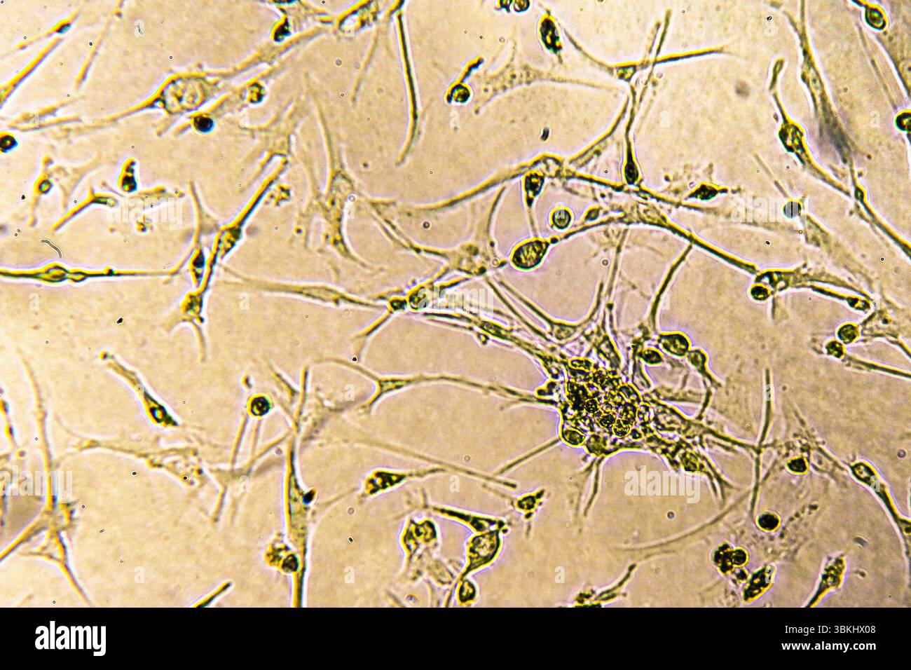 Glioblastoma cell culture. Human glioma cells under magnification Stock ...