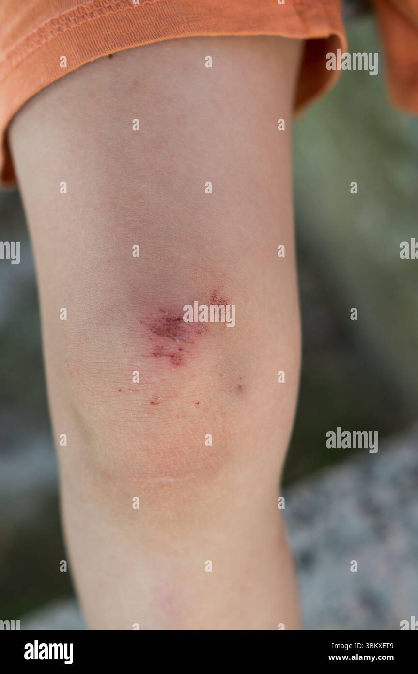 Scab scar hi-res stock photography and images - Alamy