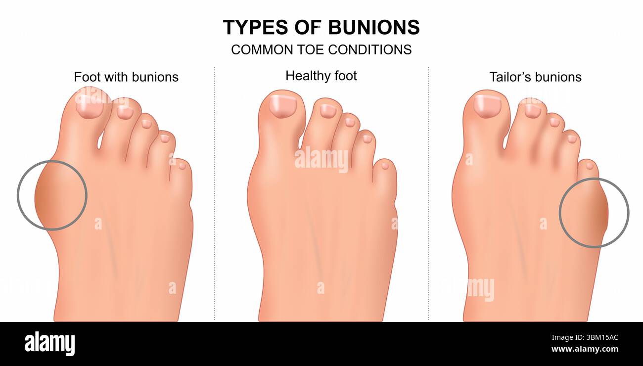 Types of Bunions Stock Photo - Alamy