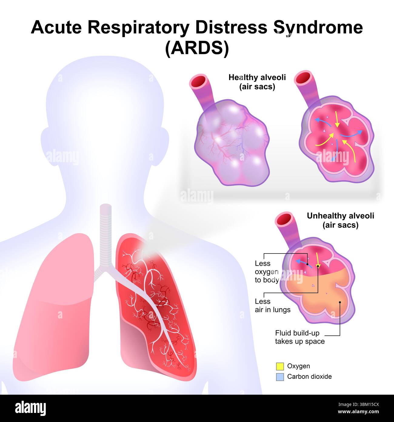 Diagnosis acute respiratory distress hi-res stock photography and ...