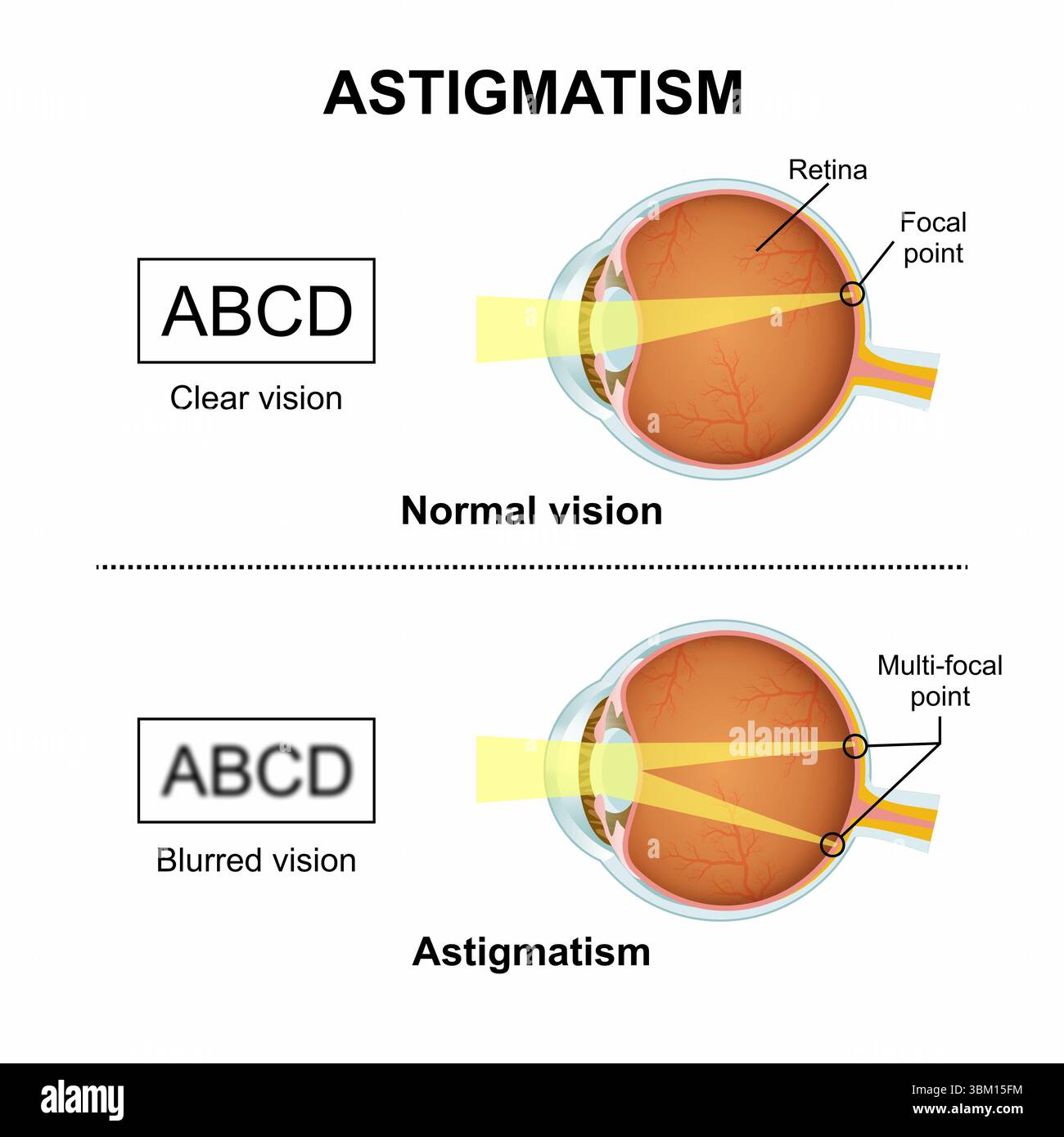 Normal astigmatism astigmatism hi-res stock photography and images - Alamy